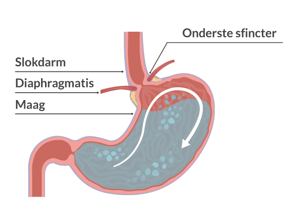De gastro-oesofageale reflux (GOR) is te wijten aan een slechte werking van het natuurlijk anti ...